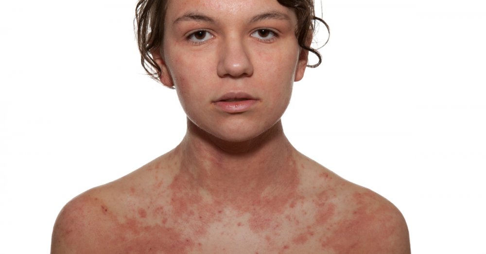 Atopický ekzém: Prírodné liečby | Bioruža